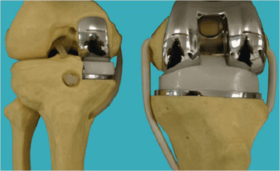 Thay khớp gối nhân tạo - Những điều cần biết
